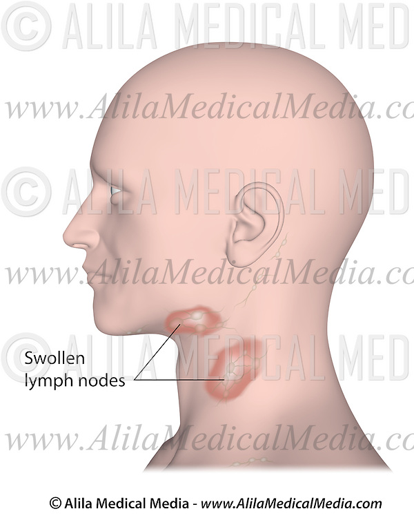 Swollen Lymph Nodes In Neck