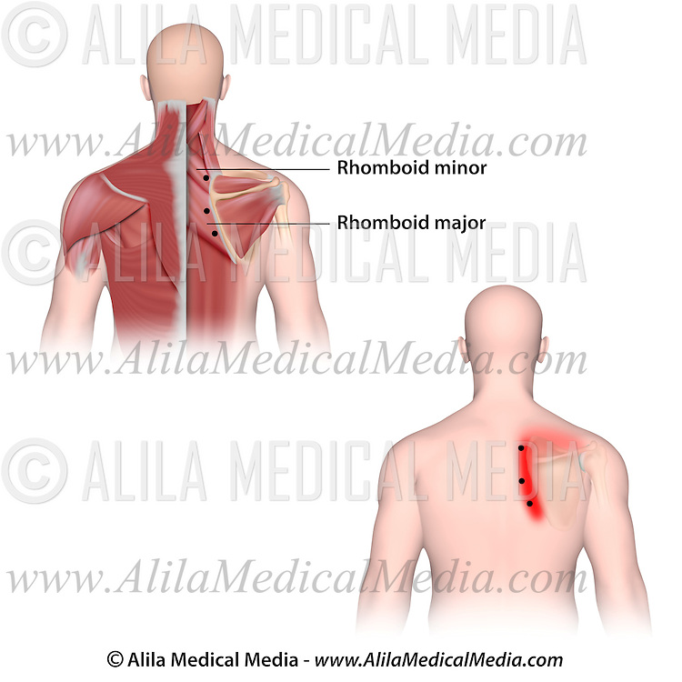 Rhomboid Major Pain